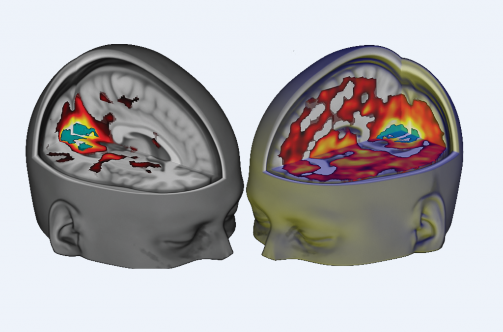 The acid test: for the first time, we know what the brain on LSD ...