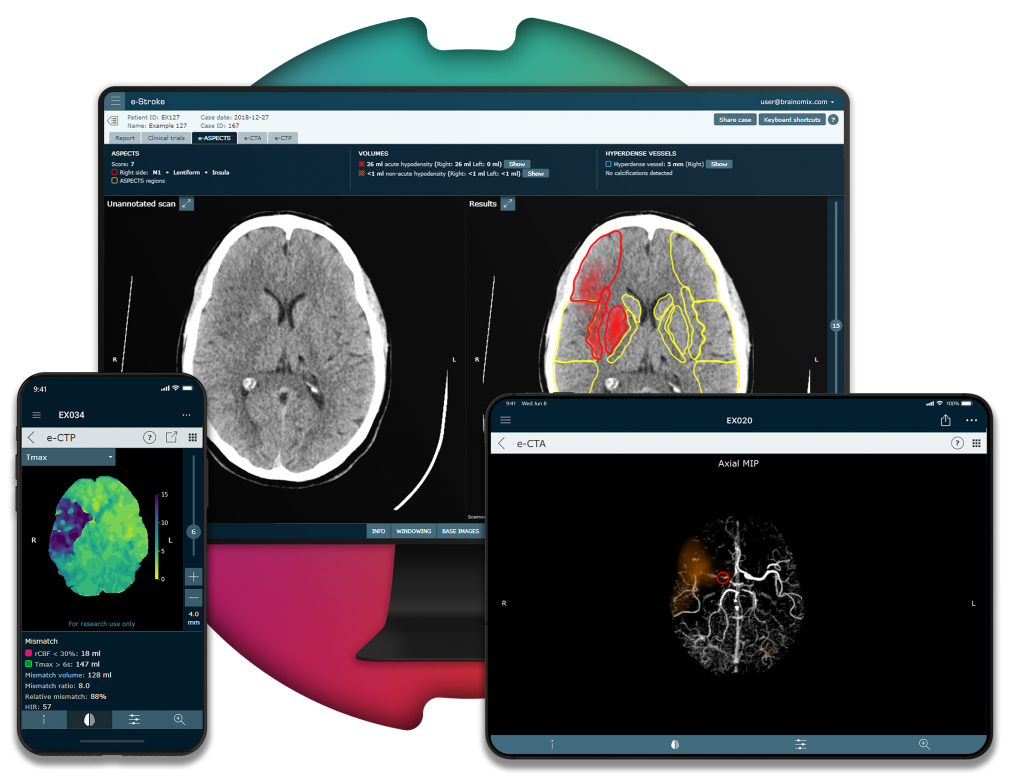 How AI is speeding up stroke care