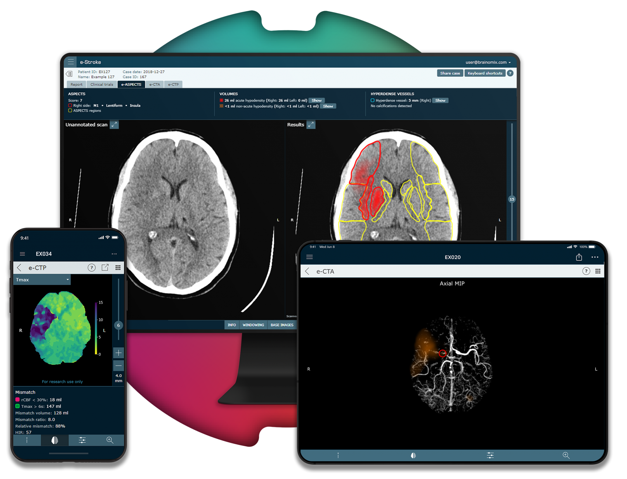 How AI is speeding up stroke care